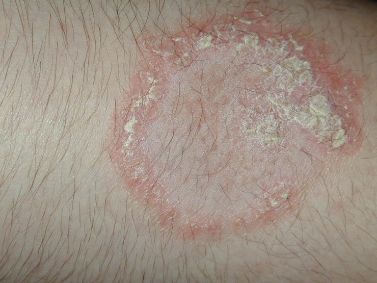 Cremă cu hidrocortizon. Pentru ce boli poate fi folosit remediul