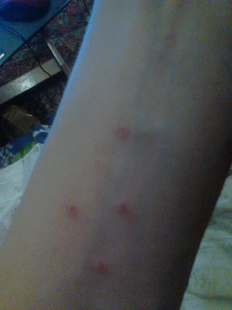 Bube de la ficat. De ce pielea suferă din cauza disfuncției hepatice?